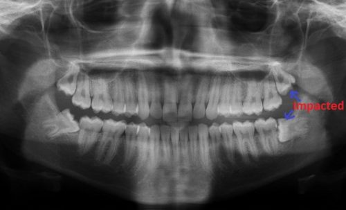 Wisdom tooth pain- know the best Advice by Dentist