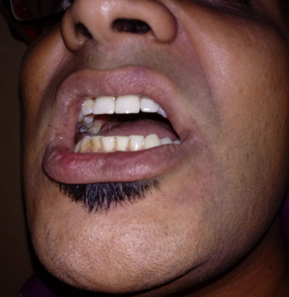 Trismus or Restricted mouth opening- Causes, Treatments