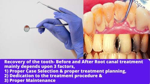 Before and After Root Canal treatment- 3 Factors of Recovery